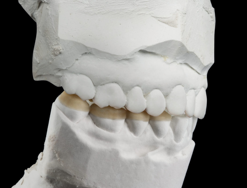 OCCLUSIONVD – edelweiss dentistry products GmbH