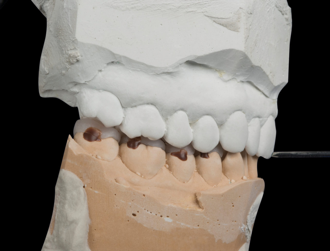 OCCLUSIONVD – edelweiss dentistry products GmbH