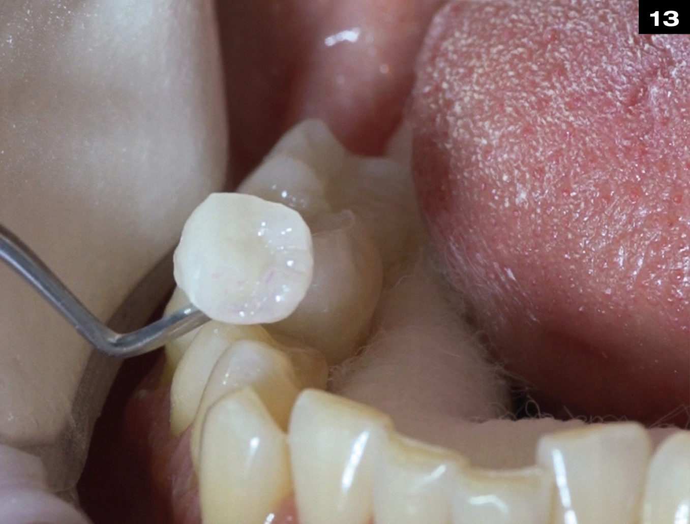 OCCLUSIONVD – edelweiss dentistry products GmbH