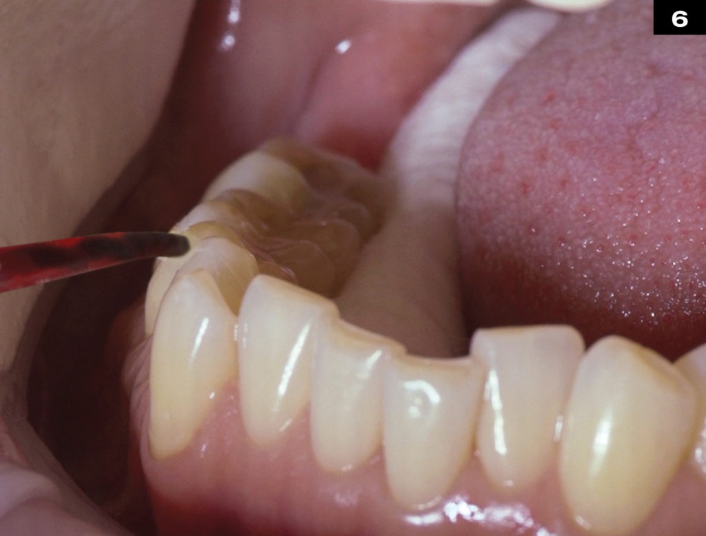 OCCLUSIONVD – edelweiss dentistry products GmbH
