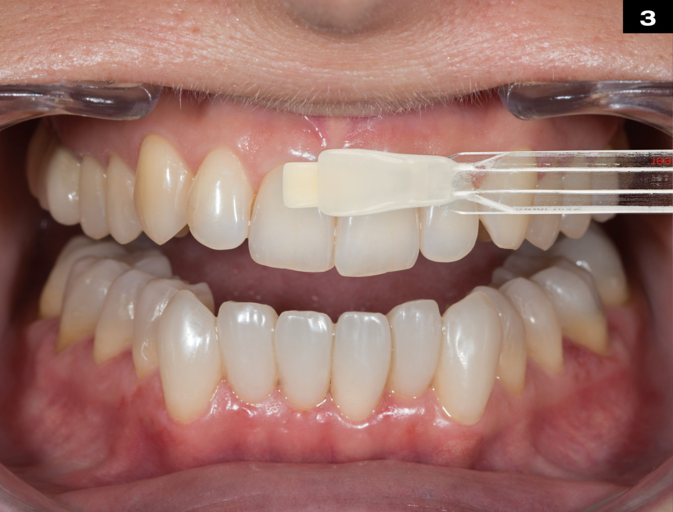 VENEER – edelweiss dentistry products GmbH