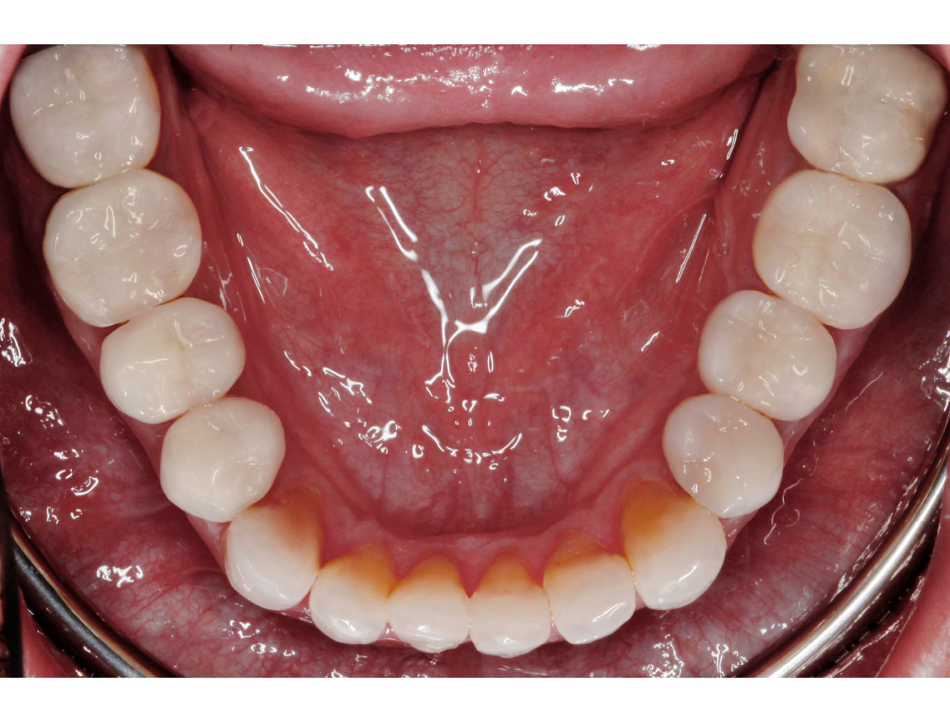 OCCLUSIONVD – edelweiss dentistry products GmbH