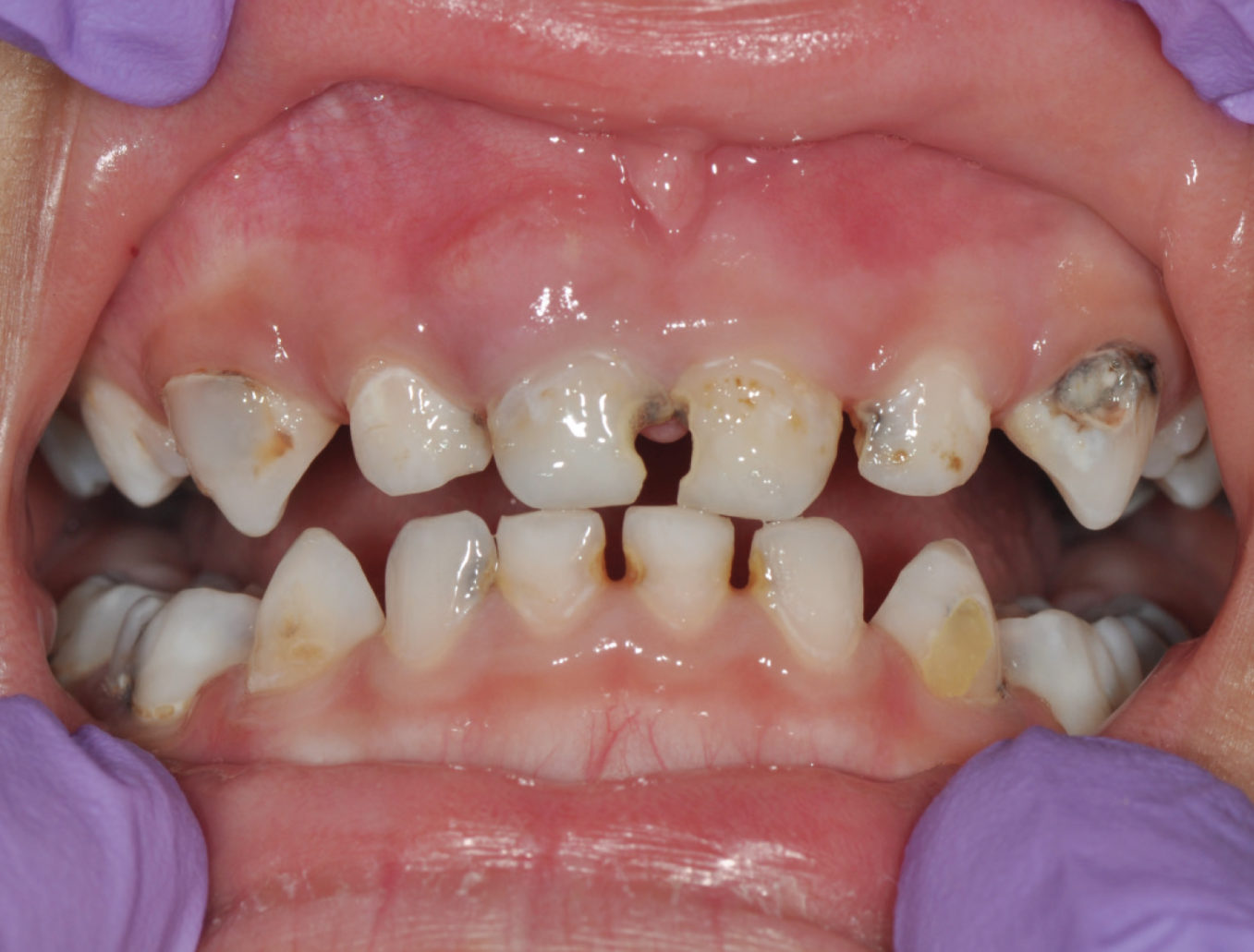 PEDIATRIC CROWN – edelweiss dentistry products GmbH