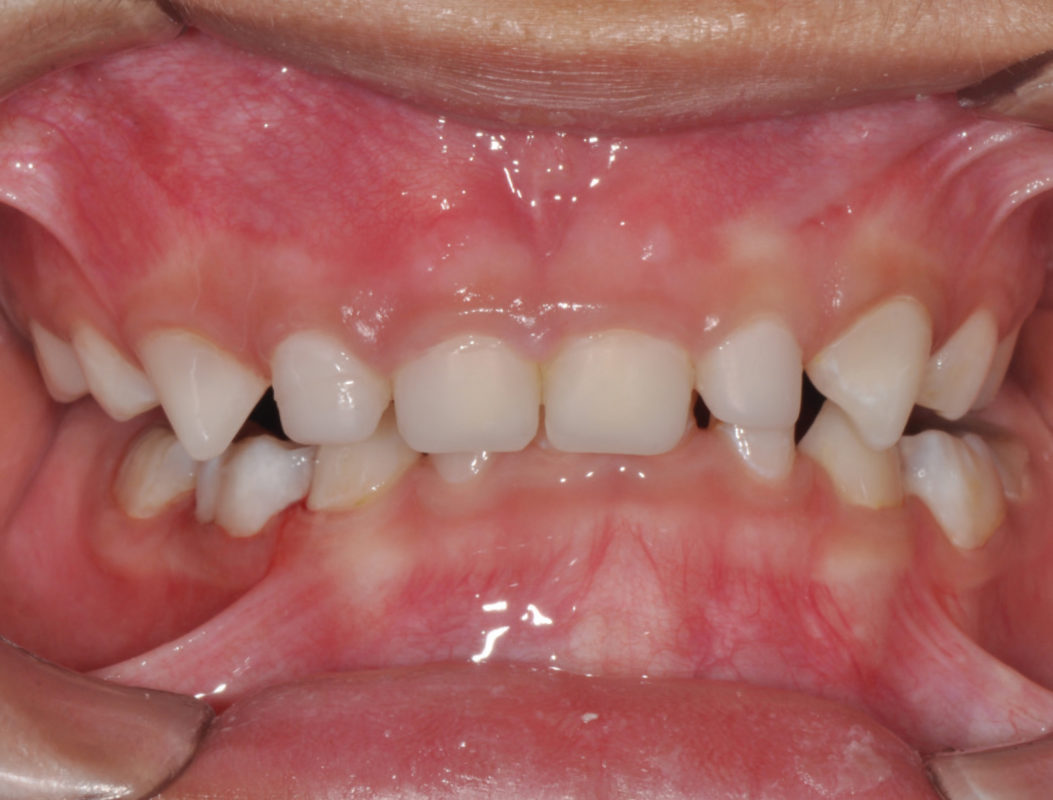 PEDIATRIC CROWN – edelweiss dentistry products GmbH