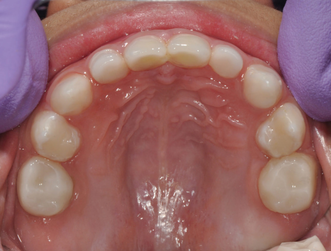 PEDIATRIC CROWN – edelweiss dentistry products GmbH