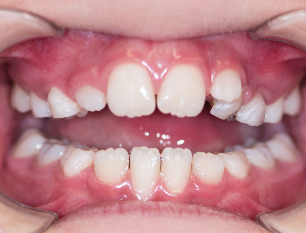 PEDIATRIC CROWN – edelweiss dentistry products GmbH