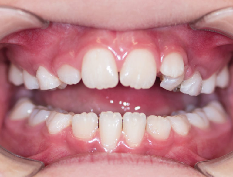 PEDIATRIC CROWN – edelweiss dentistry products GmbH