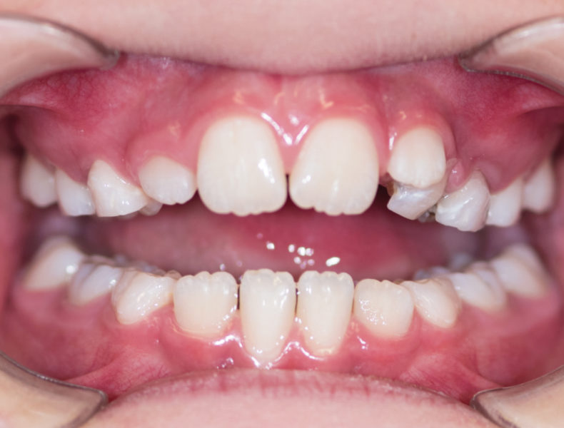 PEDIATRIC CROWN – edelweiss dentistry products GmbH