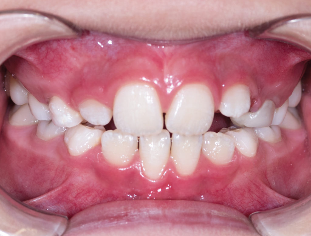 PEDIATRIC CROWN – edelweiss dentistry products GmbH