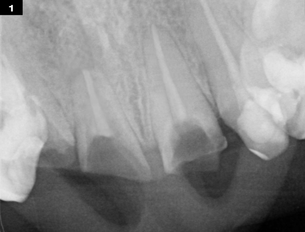 POST & CORE – edelweiss dentistry products GmbH