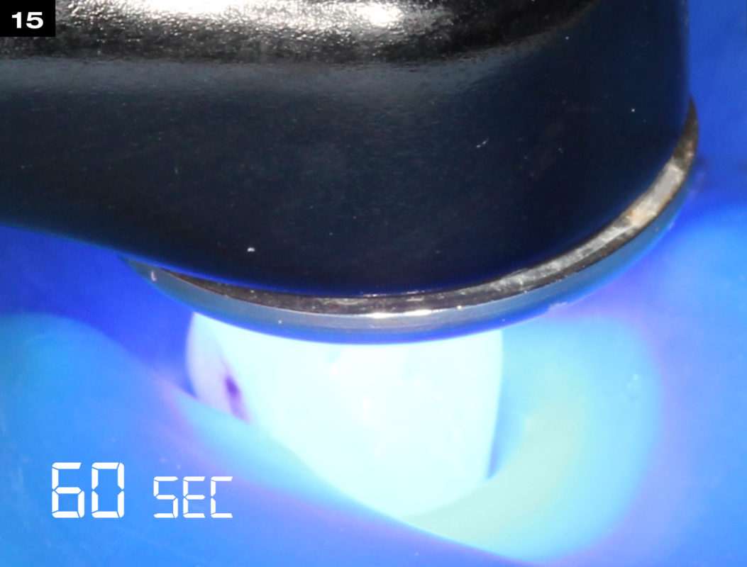 POST & CORE – edelweiss dentistry products GmbH