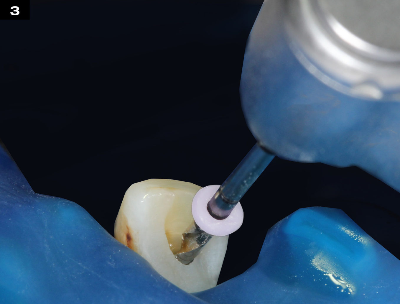 POST & CORE – edelweiss dentistry products GmbH