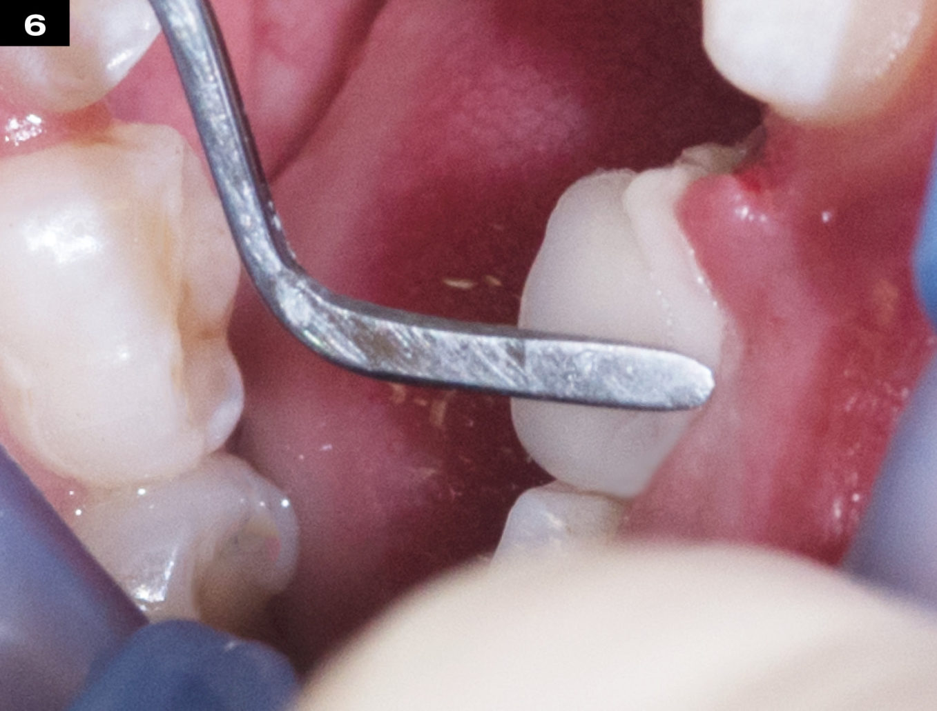 PEDIATRIC CROWN – edelweiss dentistry products GmbH