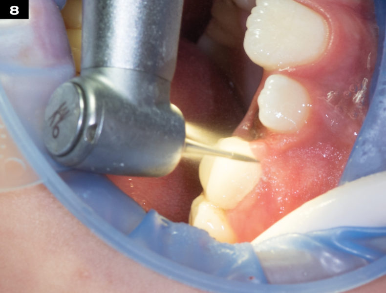 PEDIATRIC CROWN – edelweiss dentistry products GmbH