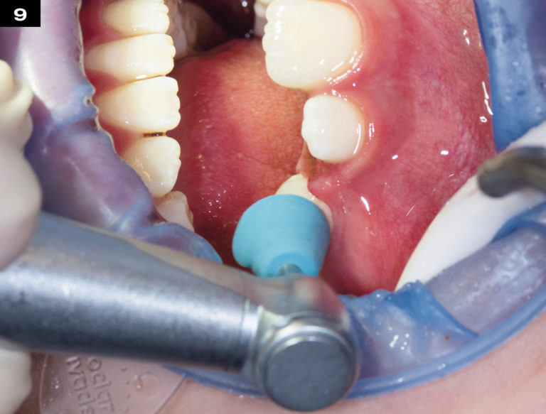 PEDIATRIC CROWN – edelweiss dentistry products GmbH